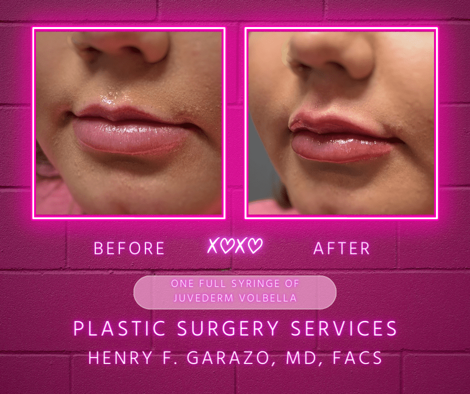 Juvederm Maryland Henry F Garazo Md Facs