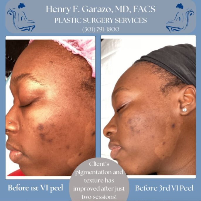 5 Ways To Optimize Your Chemical Peel Results Henry F Garazo Md Facs